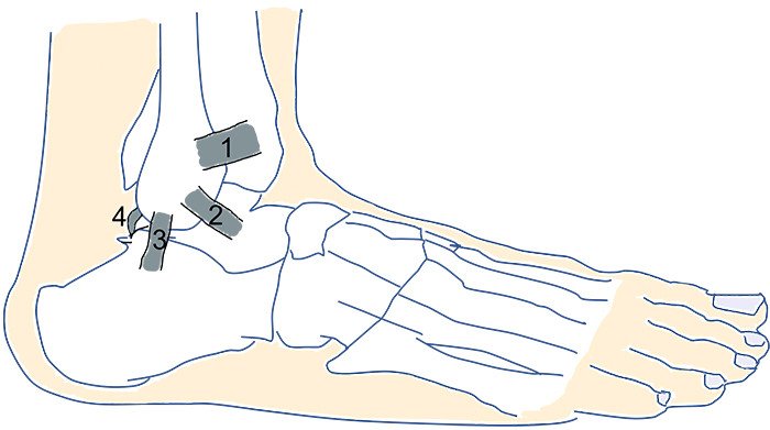 Distorsionen des Sprunggelenkes | Schulthess Klinik