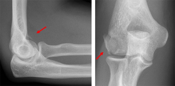 Sinnvolle Bildgebung bei Schulter- und Ellbogenverletzungen ...