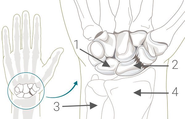 Kahnbeinbruch (Skaphoidfraktur) | Schulthess Klinik