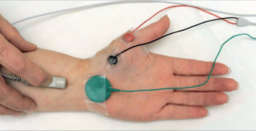 Diagnostik des Karpaltunnelsyndroms: Neurosonografie oder ...