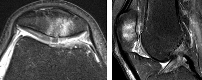 Rekonstruktion eines schweren Knorpelschadens an der Kniescheibe ...