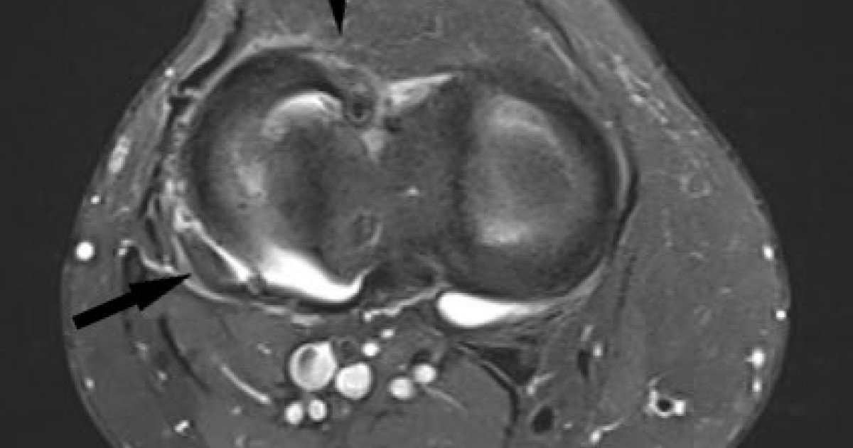 Meniskustransplantation bei symptomatischem Scheibenmeniskus ...