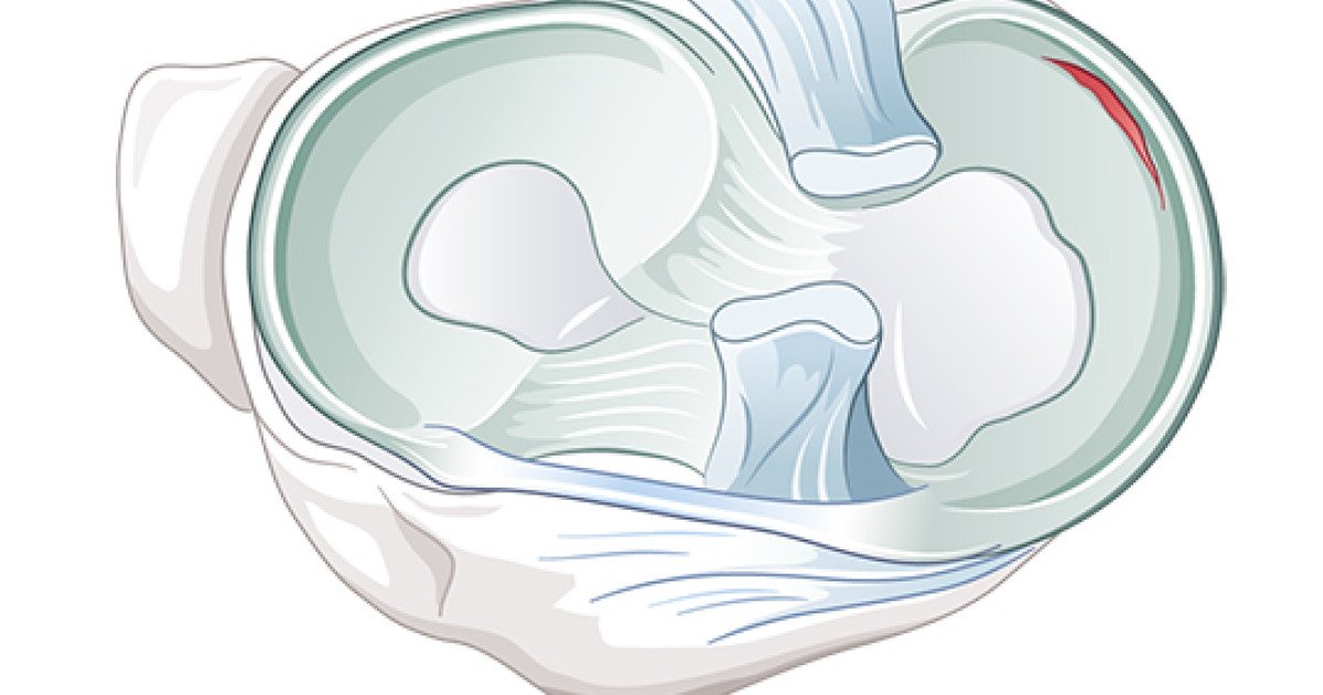 Meniskusriss / Meniskusverletzung | Schulthess Klinik