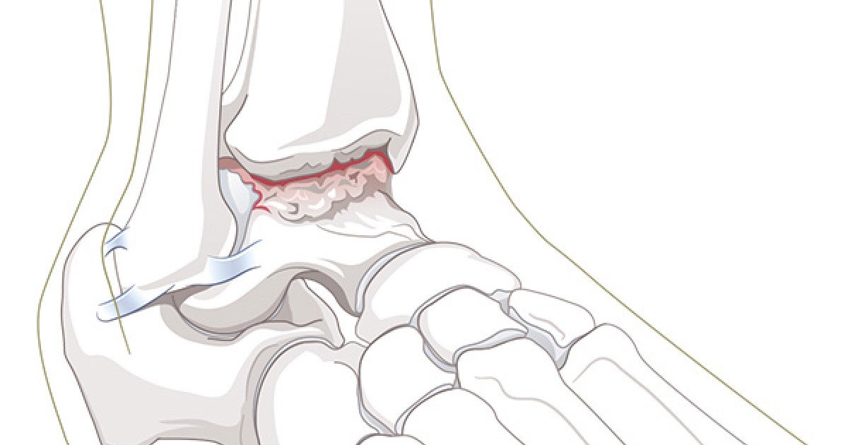 Sprunggelenksarthrose | Schulthess Klinik